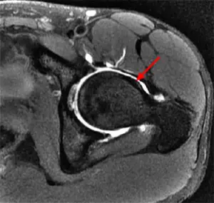 Femoral Acetabular Impingement (FAI): A Comprehensive Guide to ...