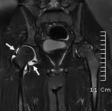 The Best Exercises for Hip Synovitis: Effective Relief Strategies - The ...